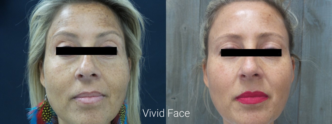 Vivid Signature Laser Facial - Laser Facial, Botox