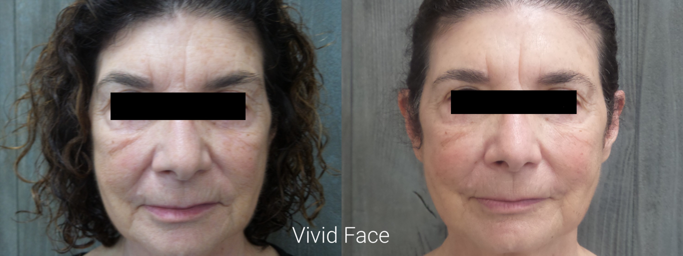 Vivid Signature Laser Facial - Laser Facial, Botox